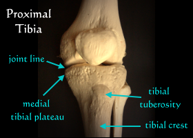 The Drift Record : "Fracture of the tibia at the medial plateau....."