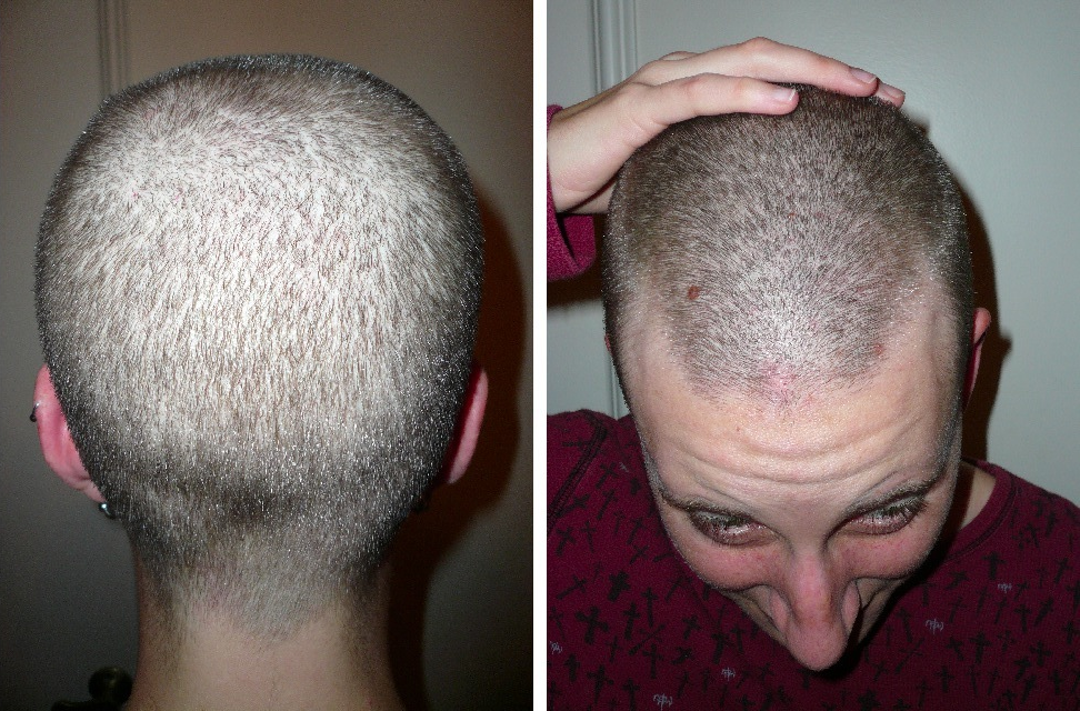 Bald Love: STILL BALD!