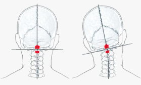 The Upper Cervical Blog: How Bad Is Head/Neck Misalignment?