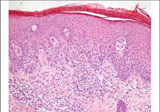 Pele: DERMATITE ECZEMATOSA AGUDA